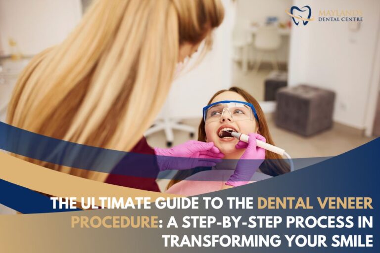 The Ultimate Guide To The Dental Veneer Procedure A Step By Step Process In Transforming Your