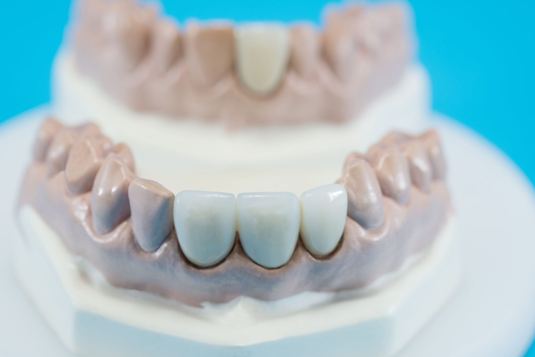 Understanding Dental Bridges Procedure and Maintenance - Maylands ...