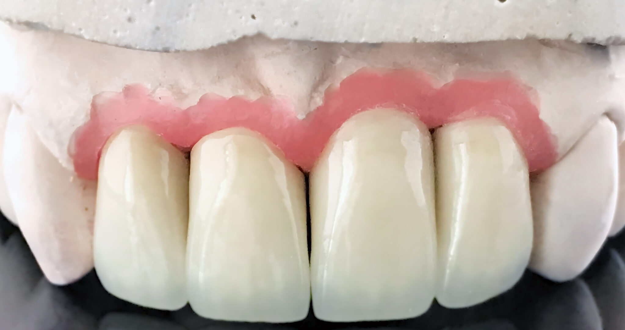 The Ultimate Breakdown of Dental Bridge Materials and Their Benefits ...